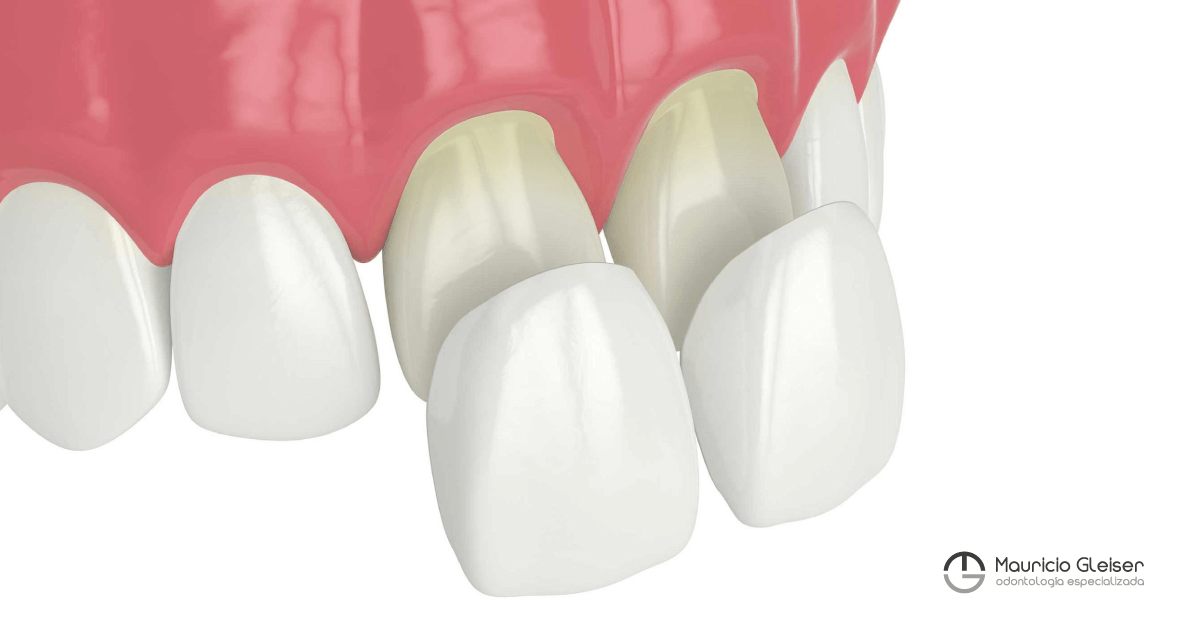 ¿Qué son las Carillas Dentales, para qué sirven y cuándo son recomendables? - Mauricio Gleiser ...