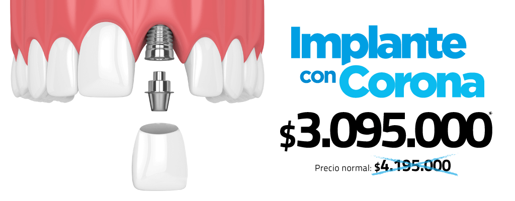 Promo Implantes - Mauricio Gleiser, Odontología Especializada